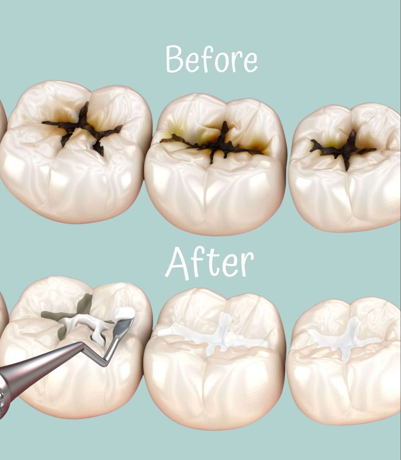 Preventive Resin Restoration For Children - Lansdowne Pediatric Dentistry