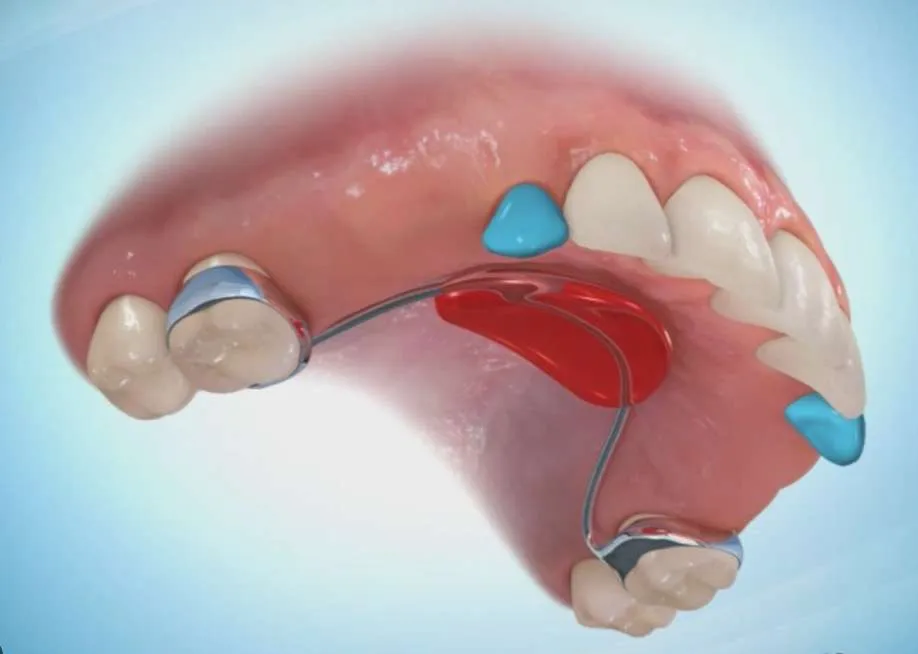 Pediatric Dental Space Maintainers - Lansdowne Pediatric Dentistry