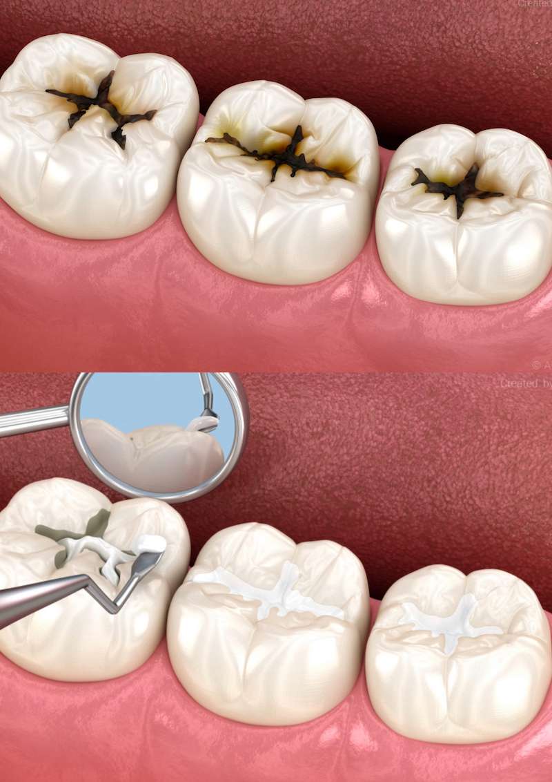 Preventative Resin Restoration for Children | Lansdowne Pediatric Dentistry