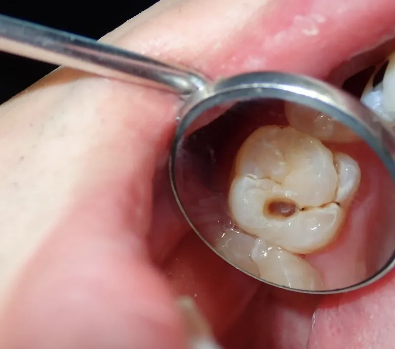 Pediatric Dental Fillings In Lansdowne, VA