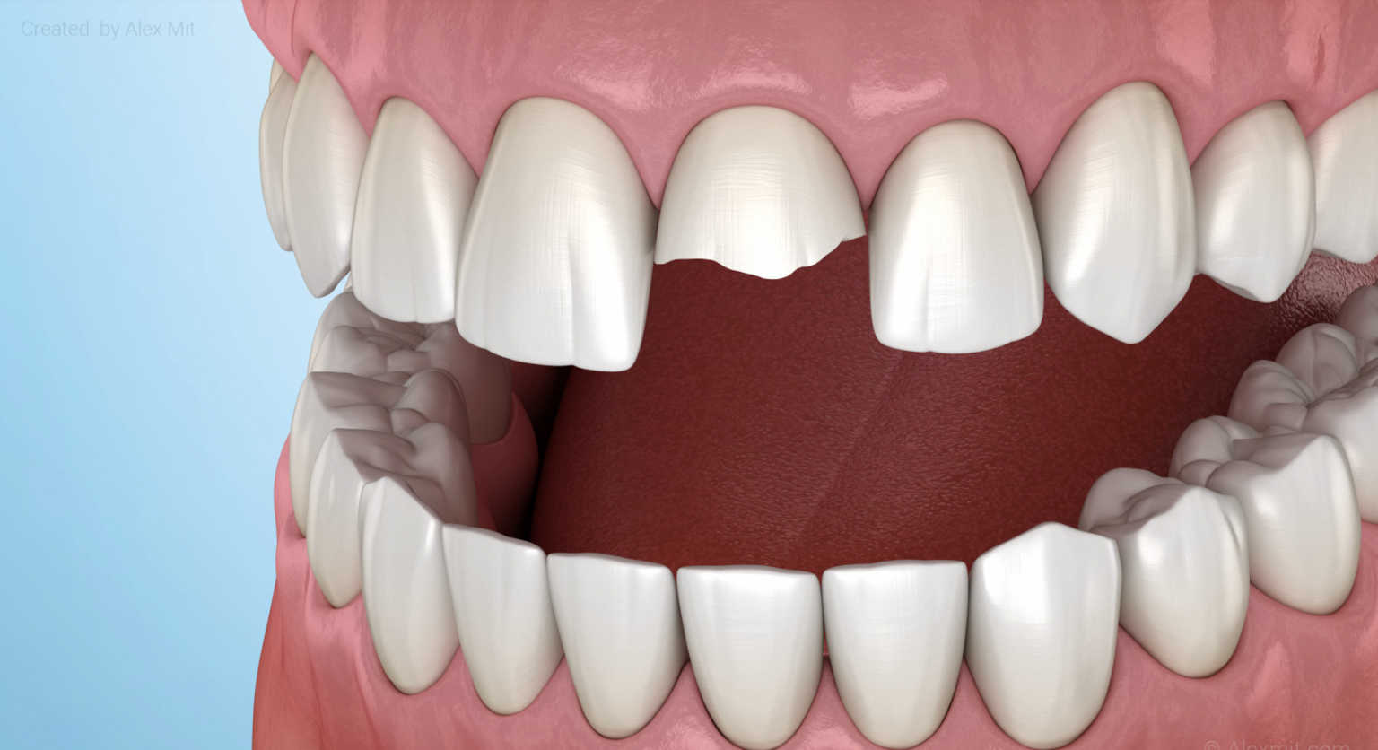 Child Dental Trauma: Tooth Fracture - Lansdowne Pediatric Dentistry